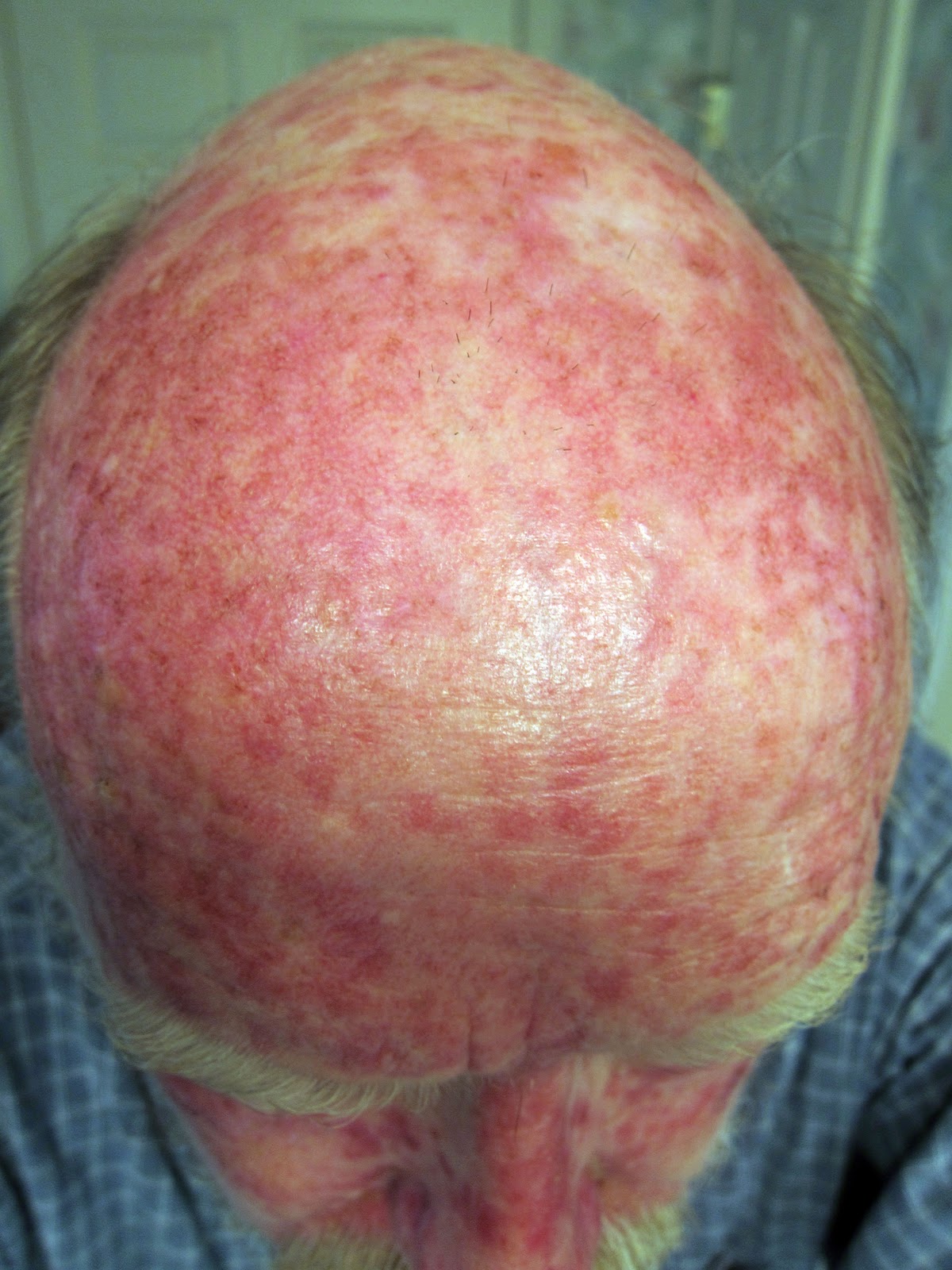 Efudex - Round Two: November 2011