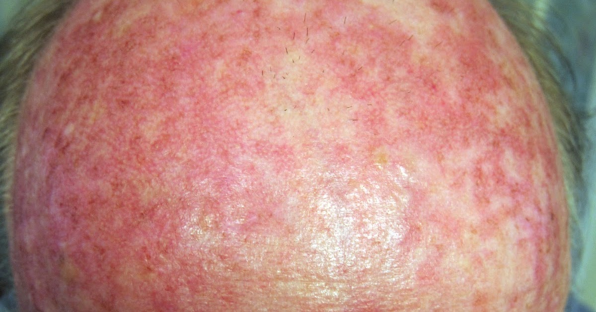 Efudex - Round Two: Day 14 - Fully Cooked!