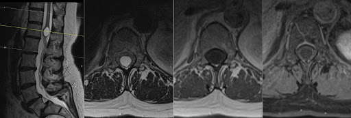 Ventriculus Terminalis - Fifth Ventricle