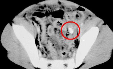 Pelvic abscess | Body Disorders And Conditions