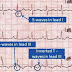 S1Q3T3 Pulmonary Embolism ECG/EKG Classic Pattern | Medical Billing and ...
