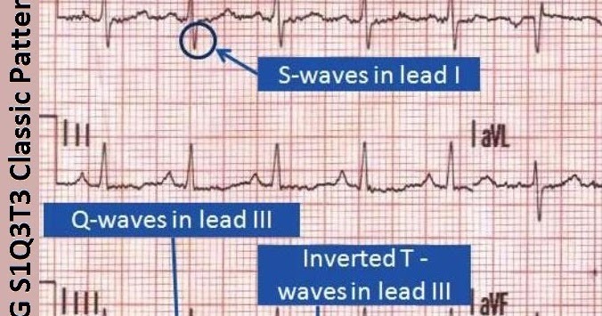S1Q3T3 Pulmonary Embolism ECG/EKG Classic Pattern | Medical Billing and ...