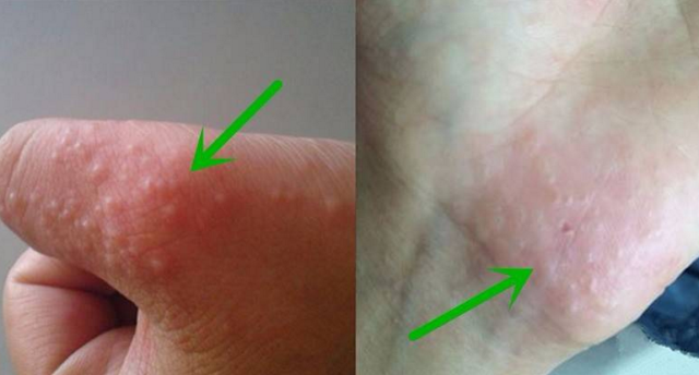 Bintik Berair dan Gatal Sering Muncul di Tangan? Banyak yang Tak Tahu ...