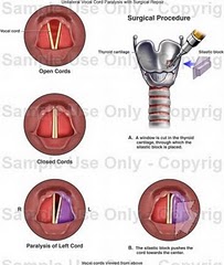 Moe's misunderestimations: Three Days Out from thyroplasty (vocal fold ...