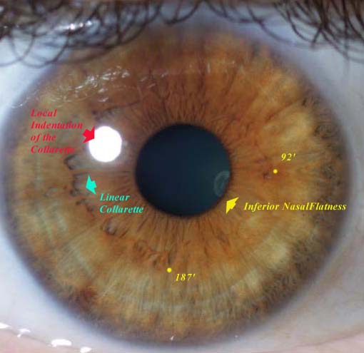 Modern & Multidimensional Iridology: Distended Collarette with Linear ...