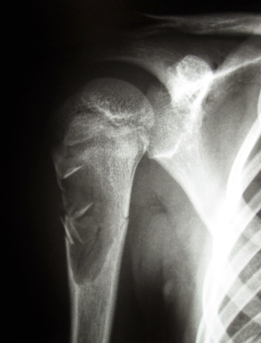 RADIOLOGIA LLEIDA: RESPUESTA A ¿ CUAL ES SU DIAGNOSTICO ? QUISTE OSEO ...