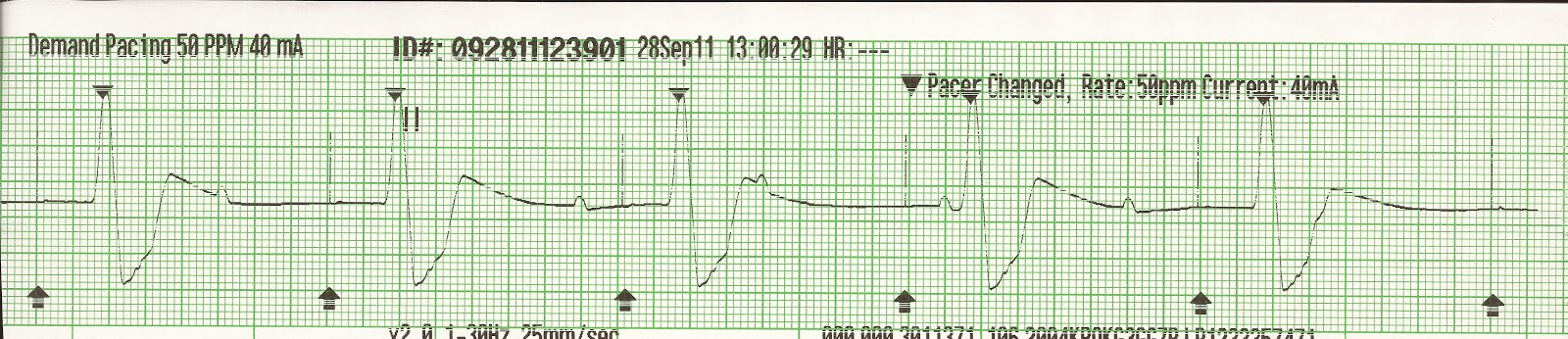 ECG Rhythm Strip Quiz 85: Electrical interventions