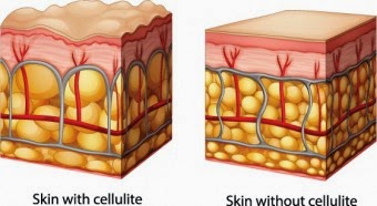 Ageless Solutions: What Causes Cellulite?