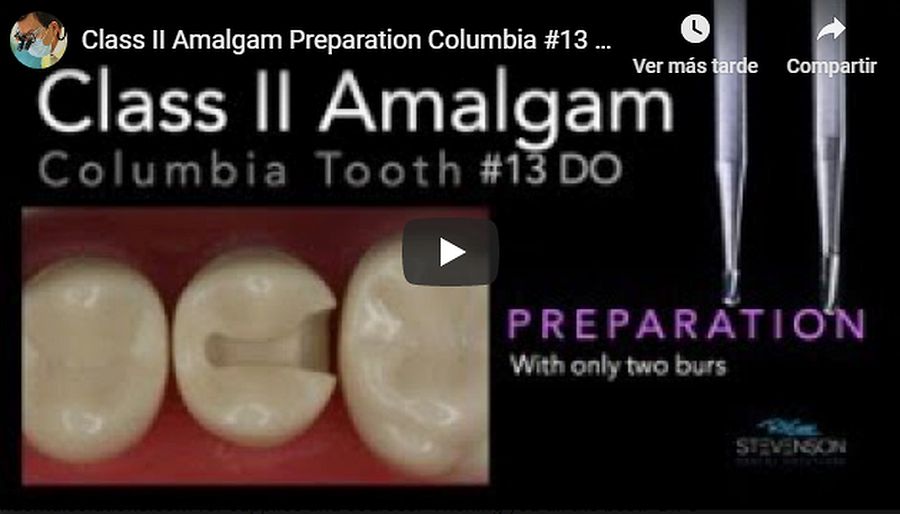 OPERATIVE DENTISTRY: Class II Amalgam Preparation Columbia #13 DO - TWO ...