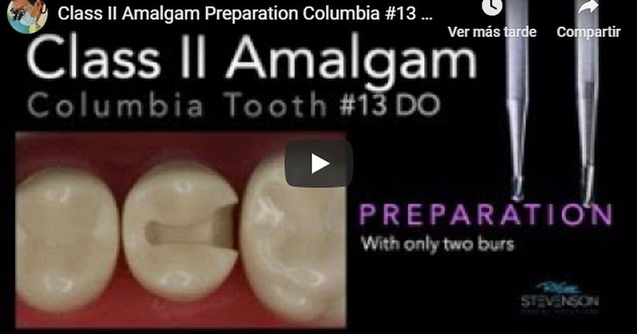 OPERATIVE DENTISTRY: Class II Amalgam Preparation Columbia #13 DO - TWO ...