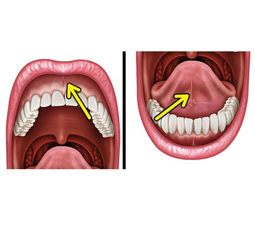 Patología de los Frenillos Bucales - OdontoVida