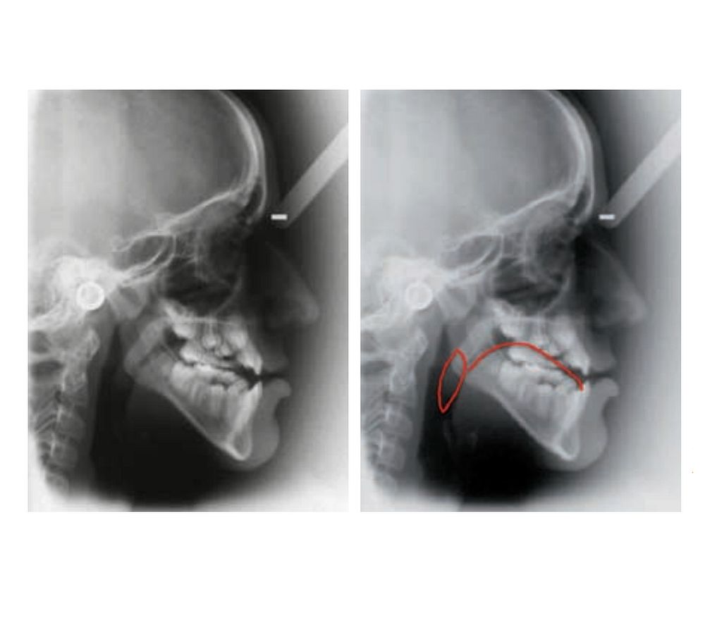 Tratamiento temprano de las clases III - OdontoVida