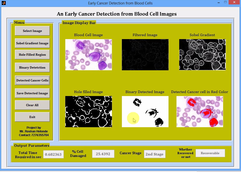 Blood Cancer (Leukemia) Detection Using Image Processing Matlab Project ...