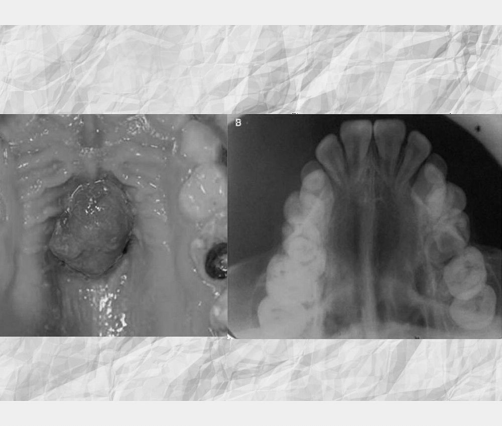 Granuloma piógeno en paciente pediátrico. Caso clínico - OdontoVida Granuloma piógeno en paciente pediátrico. Caso clínico - OdontoVida