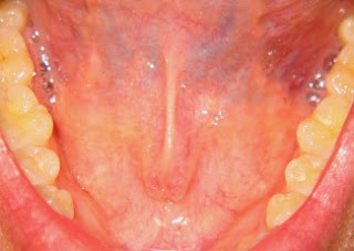 Crystal Lake Dental's Hot topics: Oral Cancer Detection with Velscope ...