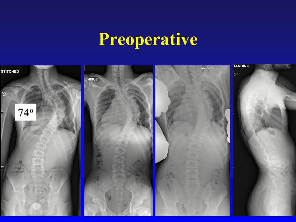Sports after Posterior Spinal Fusion T2-L2, 1 year postoperative ...