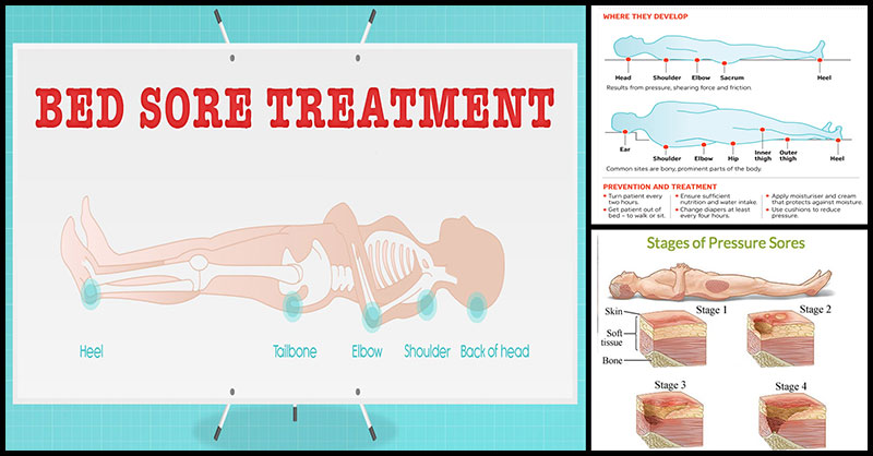 Best Home Treatment And Remedies For Bedsores | Dr Farrah MD
