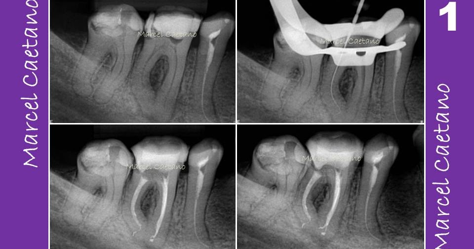 Endodontia Avançada: Um pouco sobre Anatomia do Canal, Forame Apical e ...