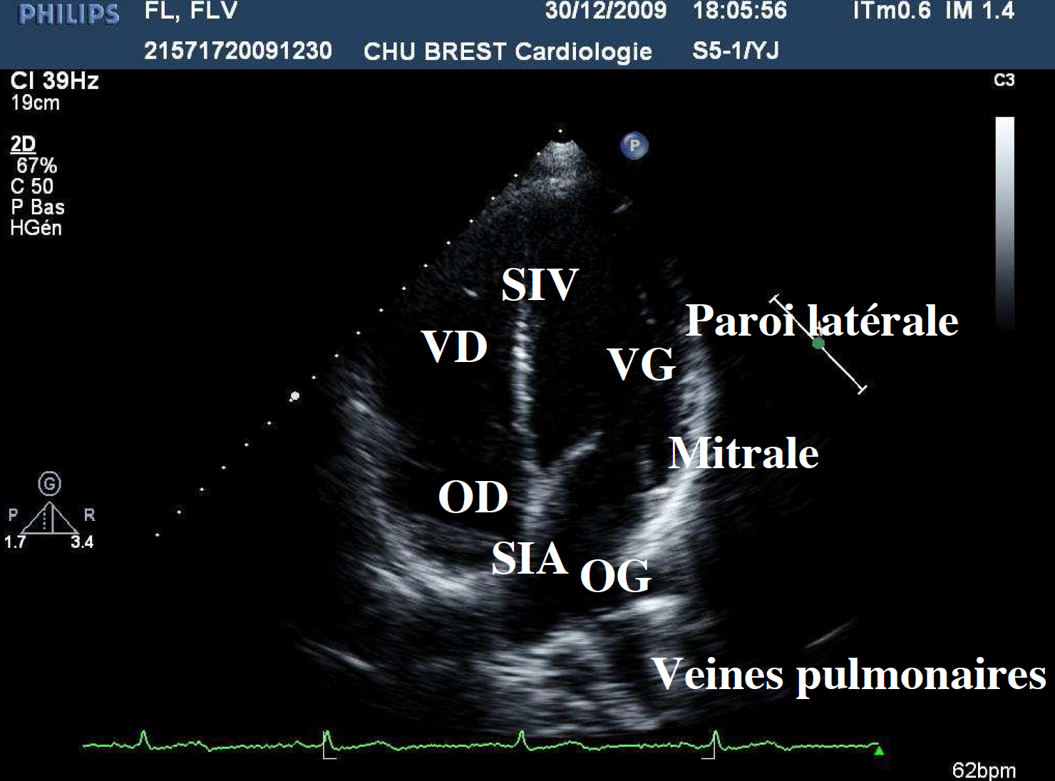 WEBANESTH: L'ETT pour les Nuls en réanimation