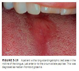 Burket’s Oral Medicine: ACUTE ATROPHIC CANDIDIASIS
