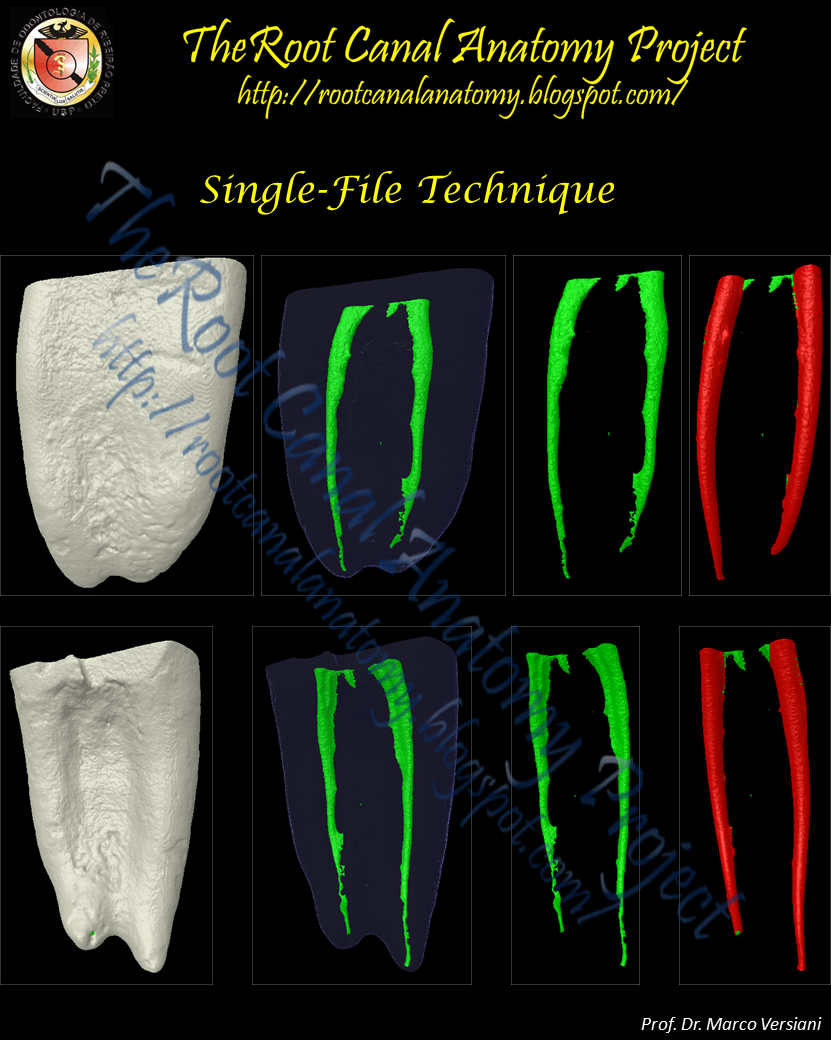 The Root Canal Anatomy Project: Single-File Technique Sample 3