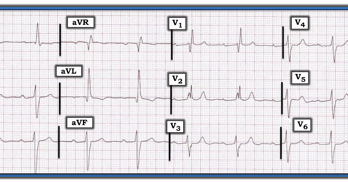 Ecg Interpretation Ecg Blog 205 — What Is Trifascicular Block