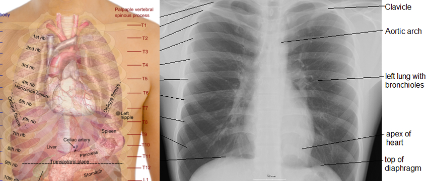 A Quick Guide to Chest X-Rays - IVLine