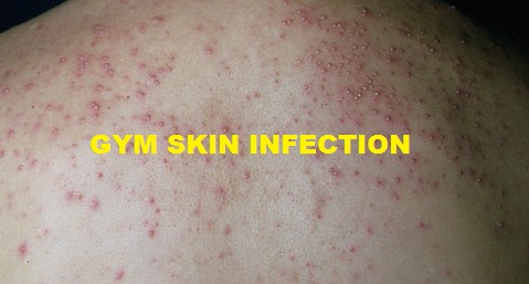 Gym Infection transmitted ~ akufisio.blogspot
