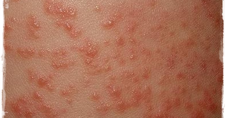 El síndrome de Gianotti - Crosti o acropapulosis infantil | Con P de ...