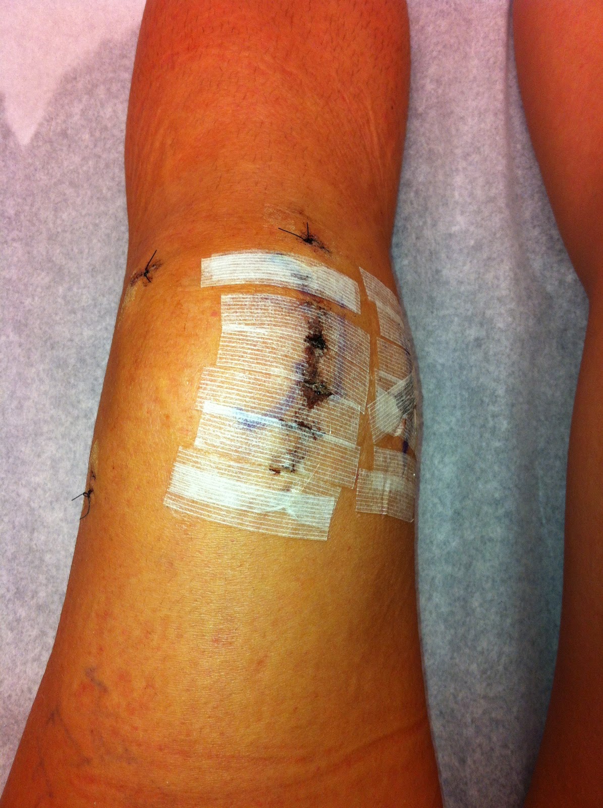MPFL Reconstruction and Microfracture Knee Surgery