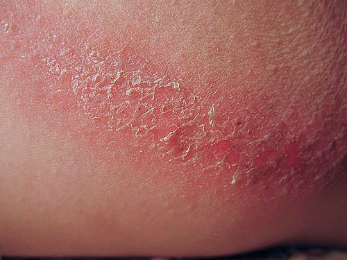 My Easy Home Remedies: Best Home Remedies For Chafing