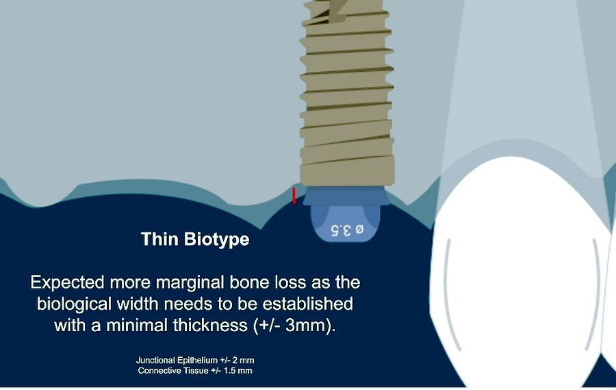 IMPLANTOLOGY: Thin Biotype marginal bone loss