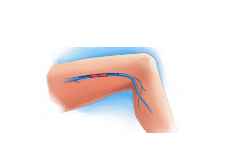 FIN DE INFARTOS, TROMBO FLEBITIS, ASMA, ARTRITIS, ÚLCERA VARICOSA ...