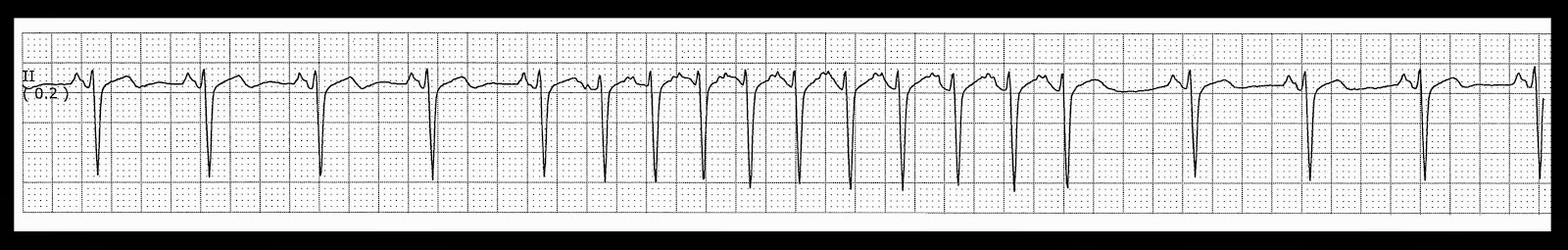 Practice EKG Strips 330