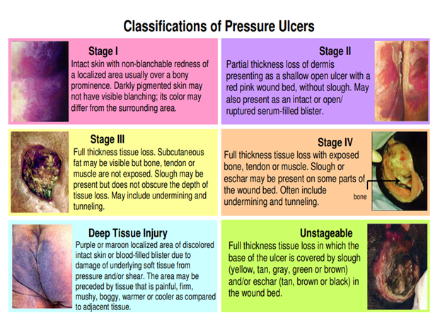PRESSURE ULCER MANAGEMENT
