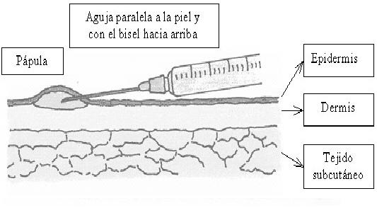 Instrumental de Enfermería: Entre dermis y epidermis: vía intradérmica
