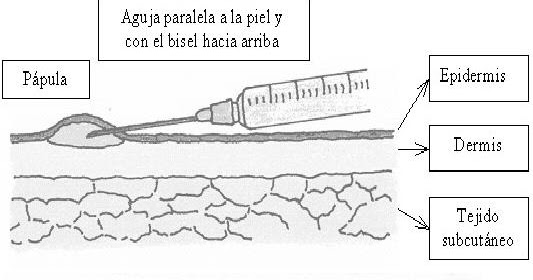Instrumental de Enfermería: Entre dermis y epidermis: vía intradérmica