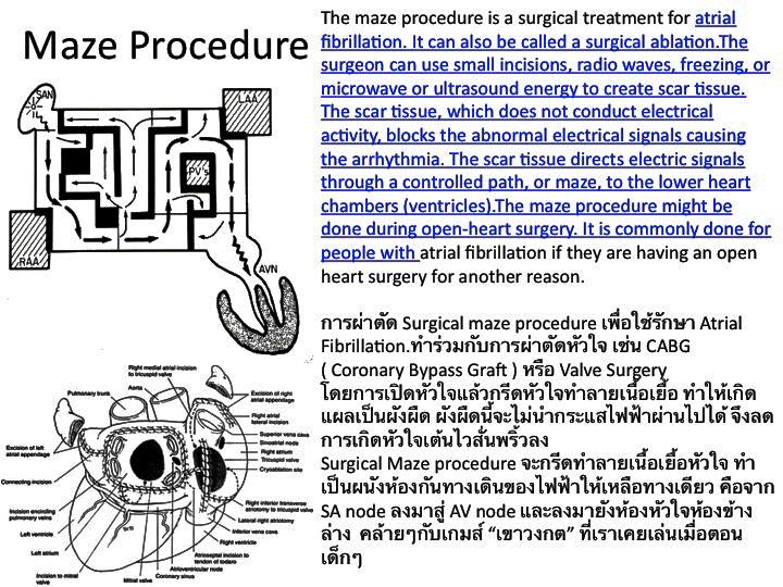 การผ่าตัด Surgical maze procedure เพื่อใช้รักษา Atrial Fibrillation