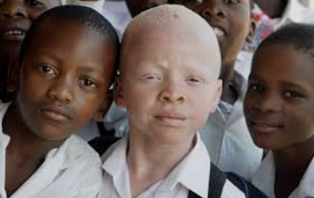 Hereditas pada Manusia : Albinisme