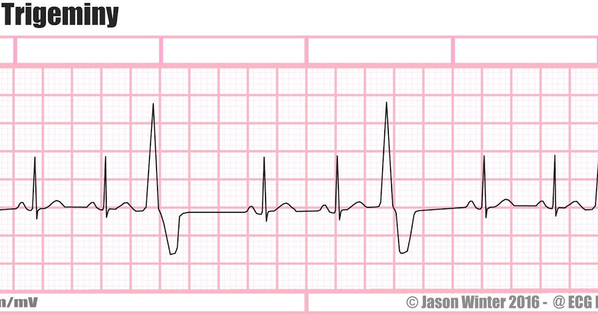 ECG Educator Blog : Ventricular Trigeminy