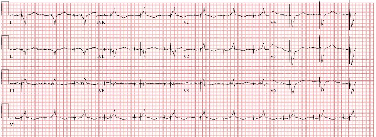Medicowesome: Determining pacemaker type from EKG (RV pacing vs ...
