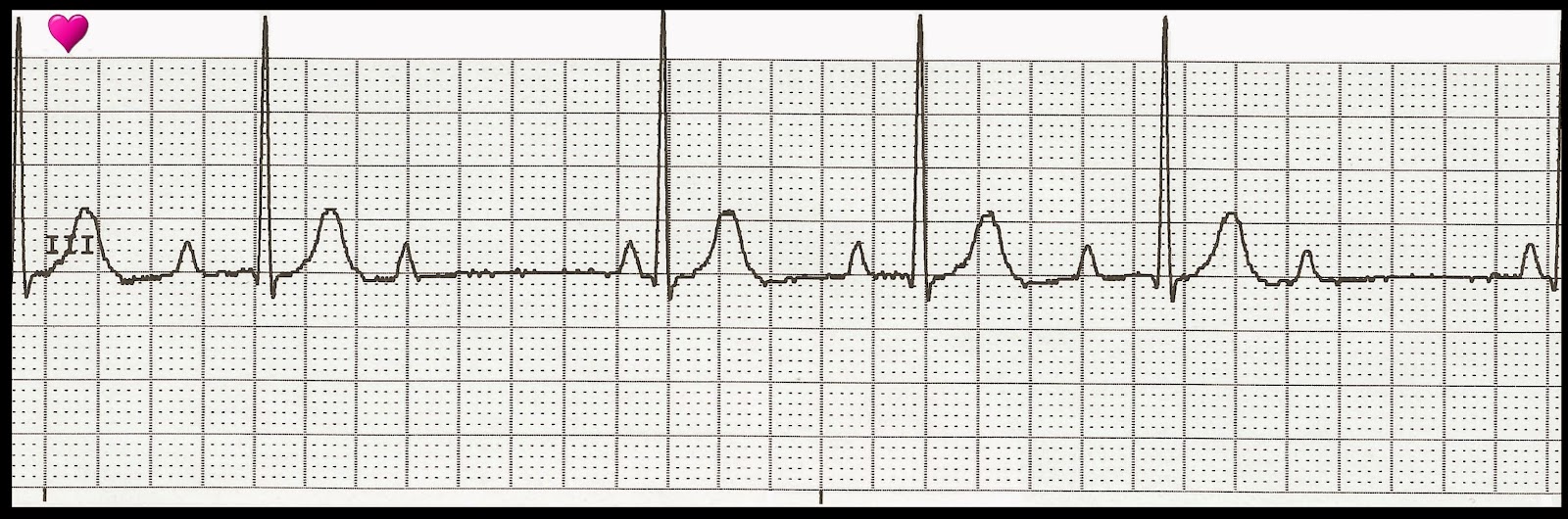 Practice EKG Strips 438