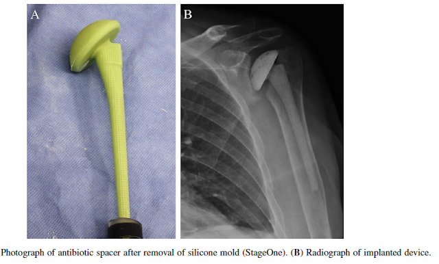 UW Shoulder and Elbow Academy: Are antibiotic spacers a benign ...