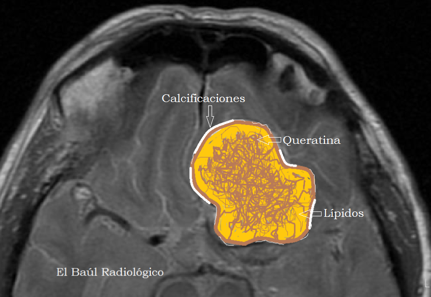 El Baúl Radiológico: 2) QUISTE DERMOIDE INTRACRANEAL (Intracranial ...
