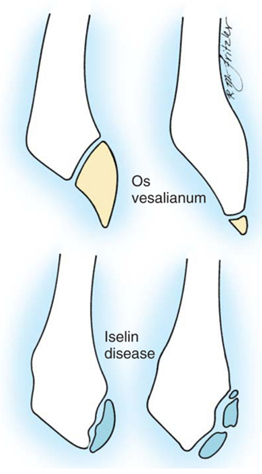 11:50: ENFERMEDAD DE ISELIN