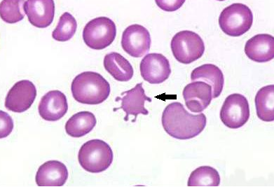 FICHERO DE HEMATOLOGÍA: ANORMALIDADES ERITROCITARIAS. Anormalidades en ...