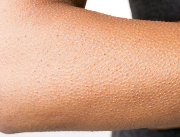 Sains Menjelaskan Apa yang Sebenarnya Terjadi Saat Kita Merinding ...