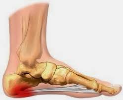 Talalgia - Inflamação Da Fáscia Plantar - Saúde & Conhecimento