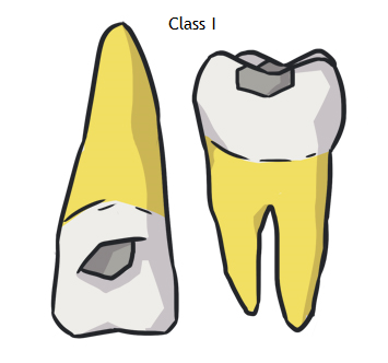 Dentasource: G. V. Black's Classifications of Tooth Decay