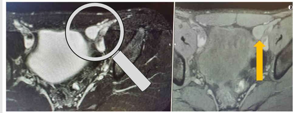 Undescended Testes MRI - Sumer's Radiology Blog
